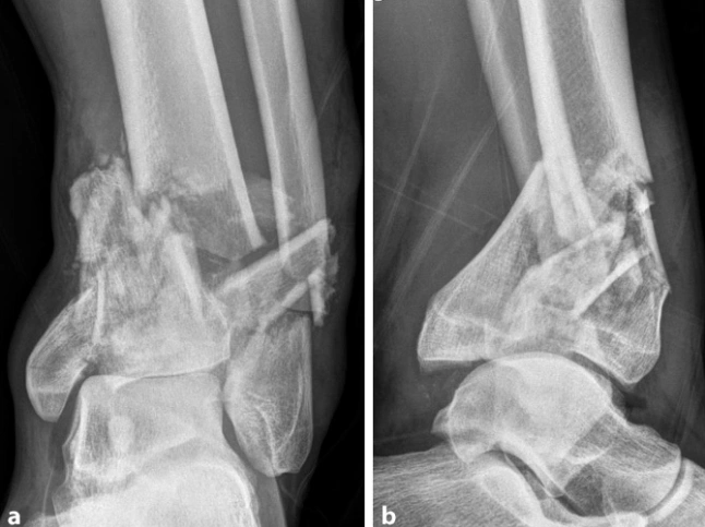 Fraturas Complexas de Pilon: Princípios Cirúrgicos, Técnicas ORIF e o ...