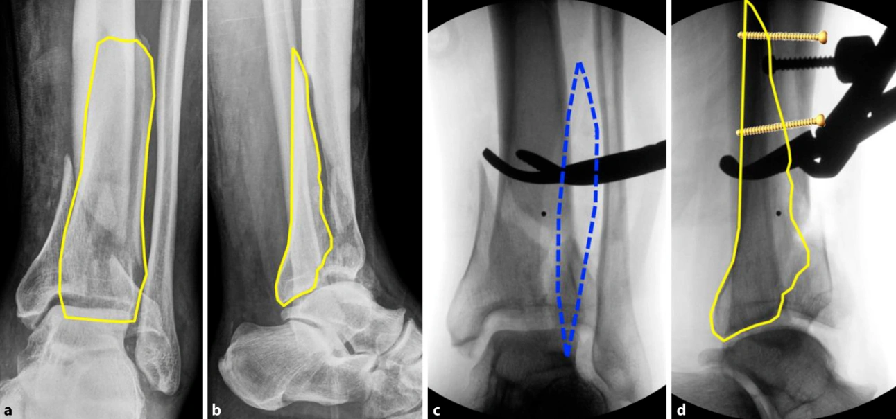 Fraturas Complexas de Pilon: Princípios Cirúrgicos, Técnicas ORIF e o ...
